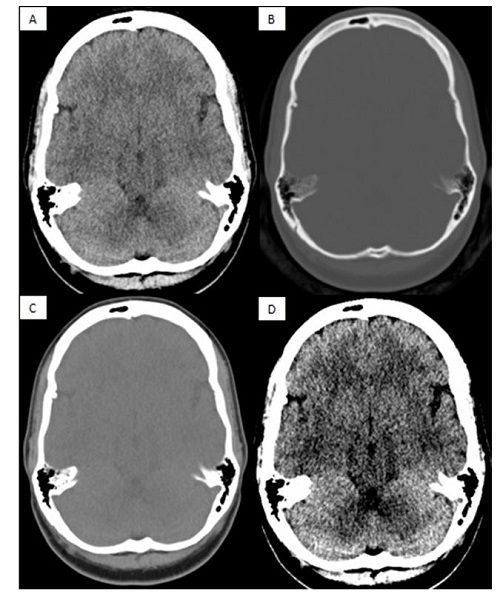 How To Interpret An Unenhanced Ct Brain Scan Part 1 Basic Principles