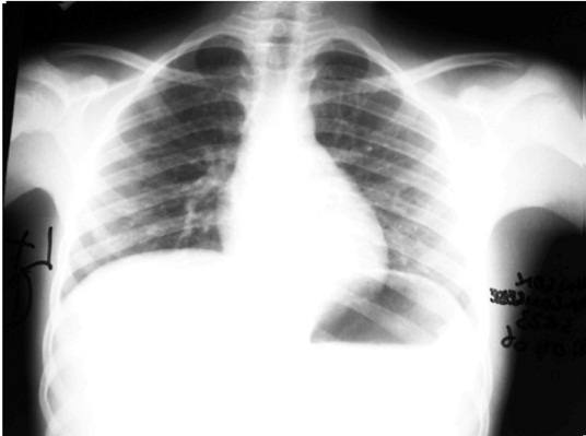 Enlarged Liver X Ray